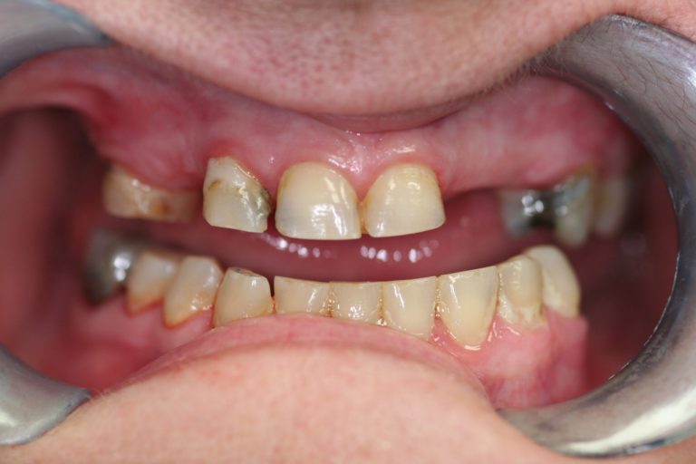 RPD Crowns - Bogey Hills Dental